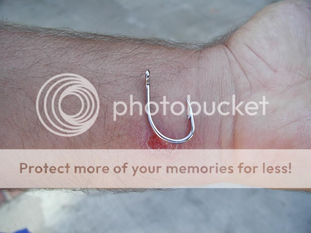 finger / hand injuries when fighting fish | Bloodydecks